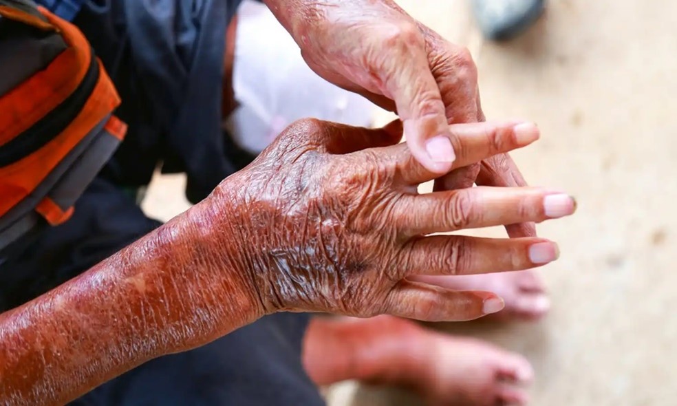 Inilah Cara Apoteker Dalam Membantu Memerangi Scleroderma! - IAI NEWS